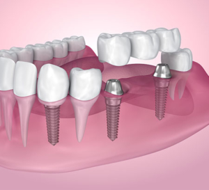 Prothèse conventionnelle - Bridge, Couronne dentaire, Inlay core